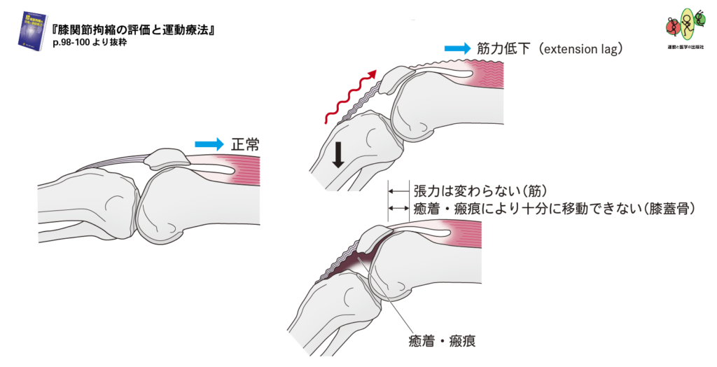 臨床ヒント『extention lagの要因と評価』 - 株式会社 運動と医学の出版社（UGOITA）
