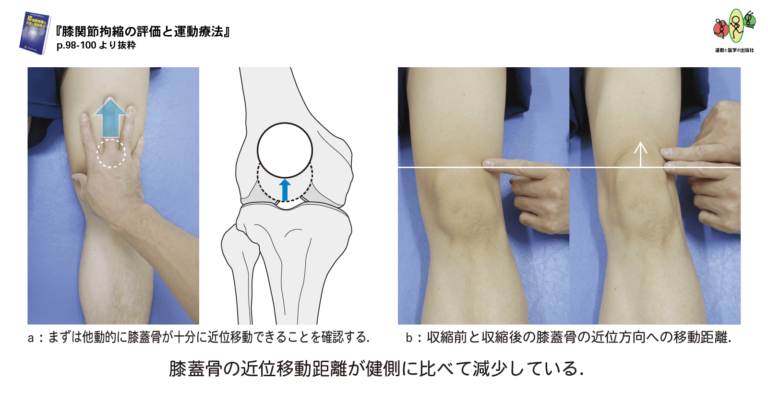 臨床ヒント『extention lagの要因と評価』 - 株式会社 運動と医学の出版社（UGOITA）